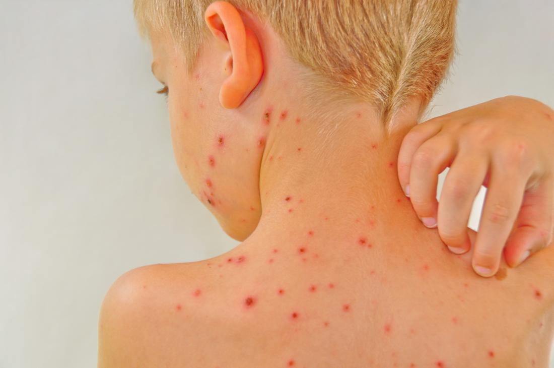 Apa Itu Chicken Pox Ketahui Lebih Lanjut Berkenaan Simptom Punca Dan
